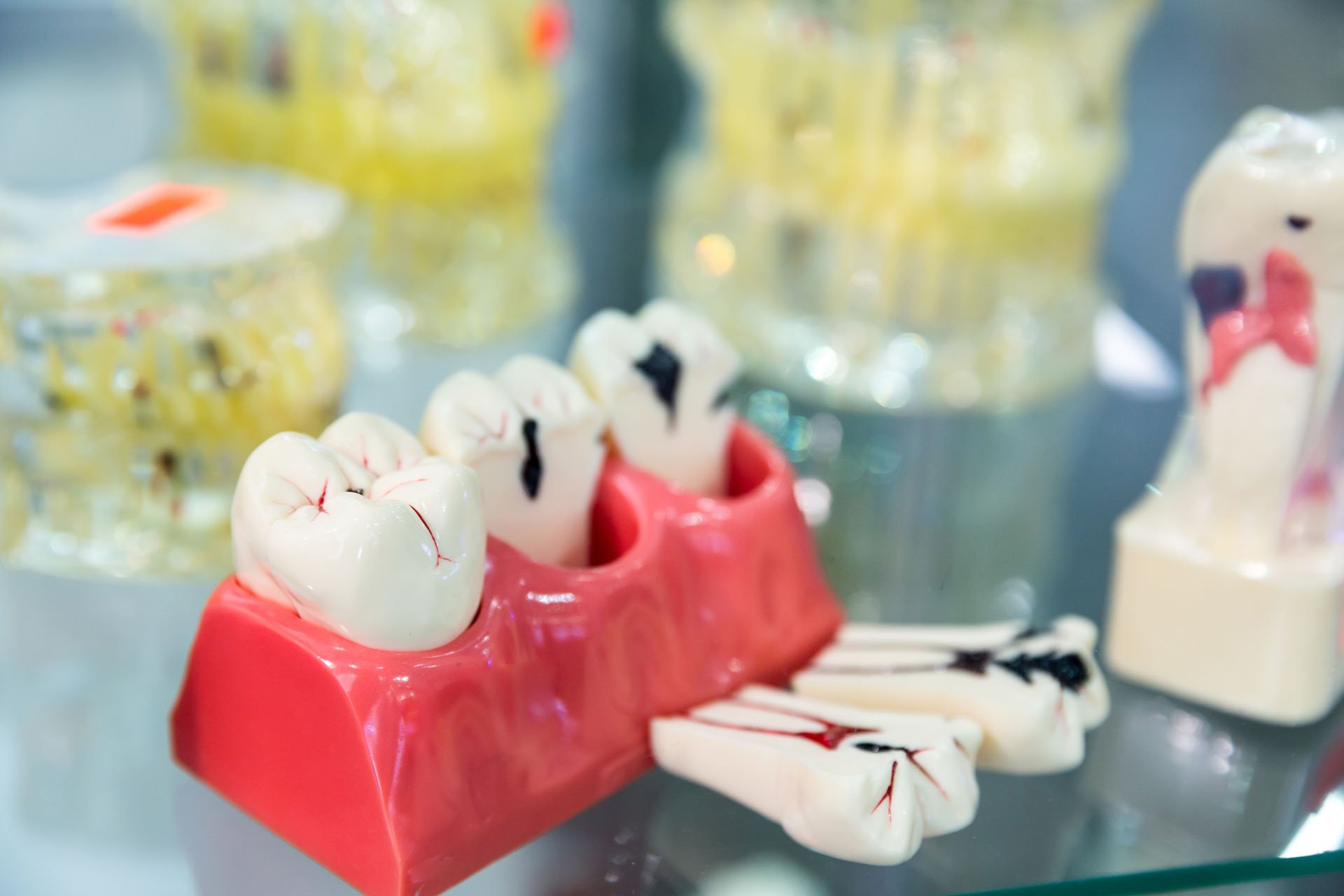 Što je karijes i kako ga se riješiti? | Stomatološka ordinacija Rijeka ...